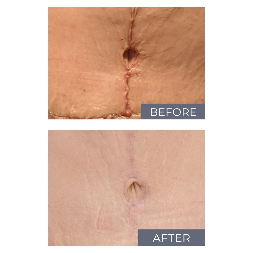 Silicone Gel Treatment Kit for Body Scars – Scar Kit